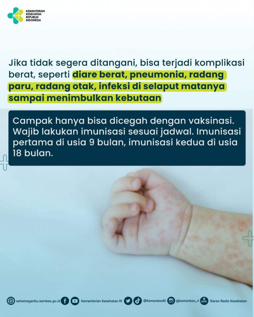 WASPADA, CAMPAK JADI KOMPLIKASI, SEBABKAN PENYAKIT BERAT | Diskes Badung